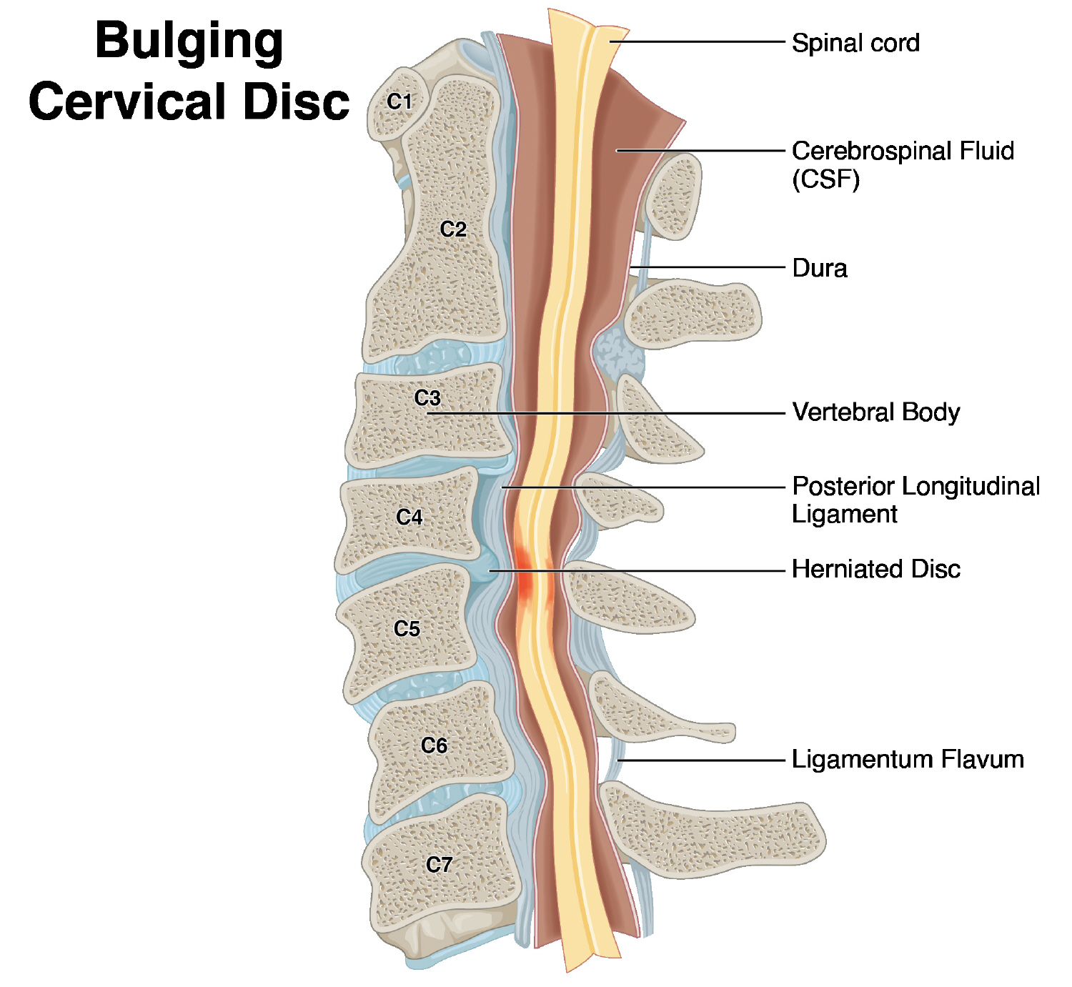 Do I Have A Bulging Disc Back Cervical Bulged Disc How To Heal A