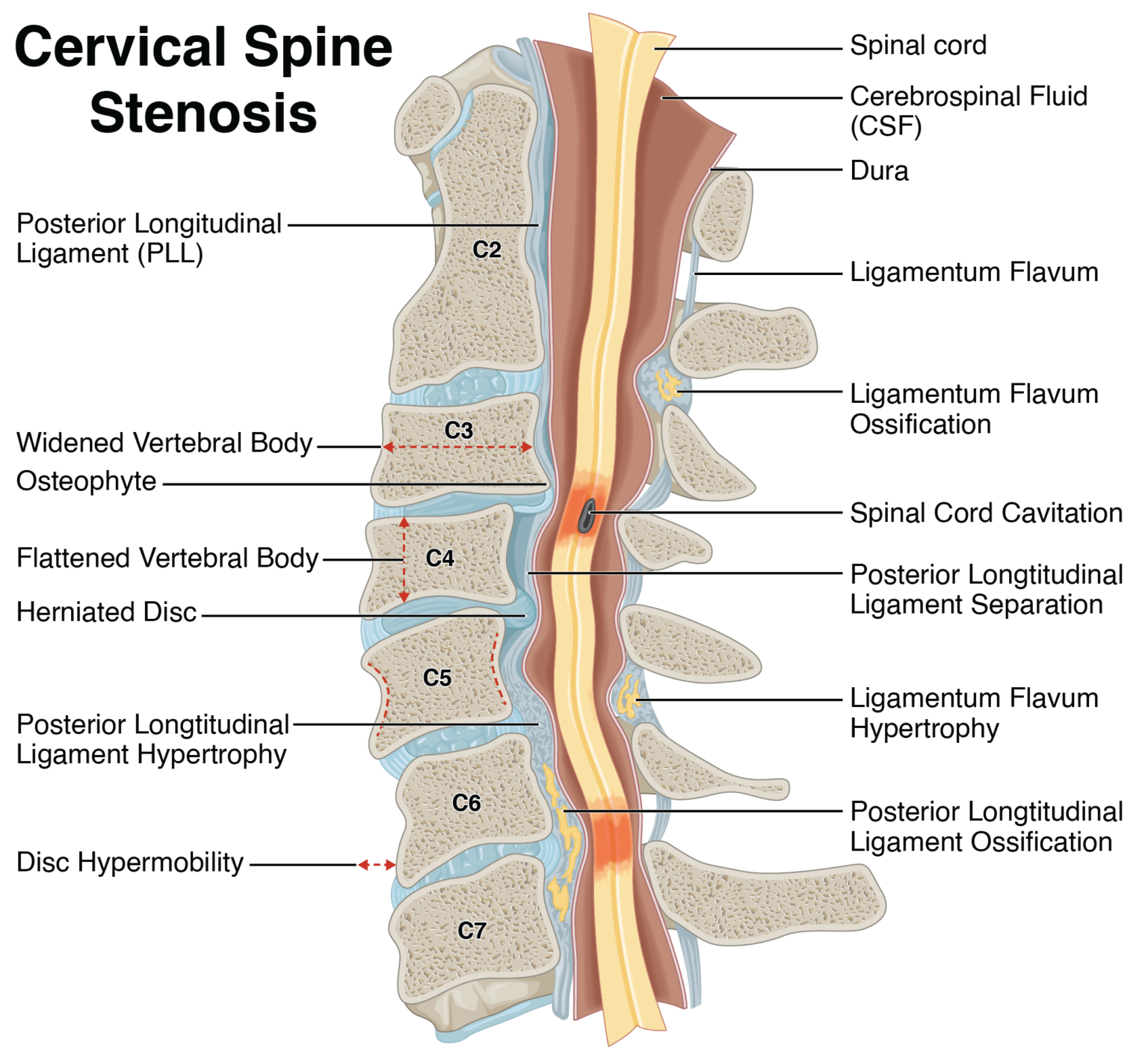 Spinal Stenosis | Norelle Health
