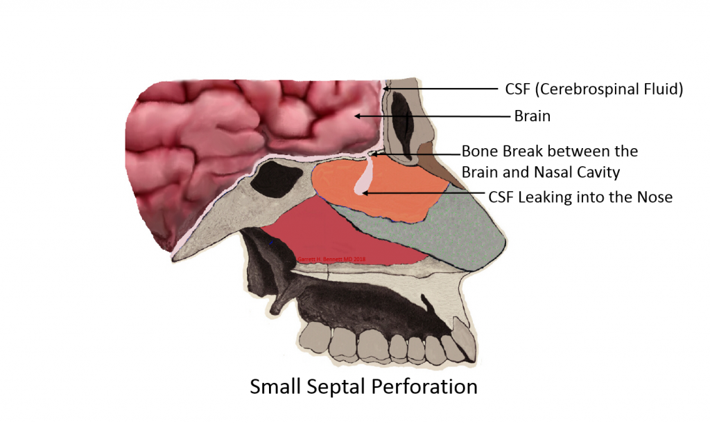 Nasal Septal Perforation Surgery | Norelle Health