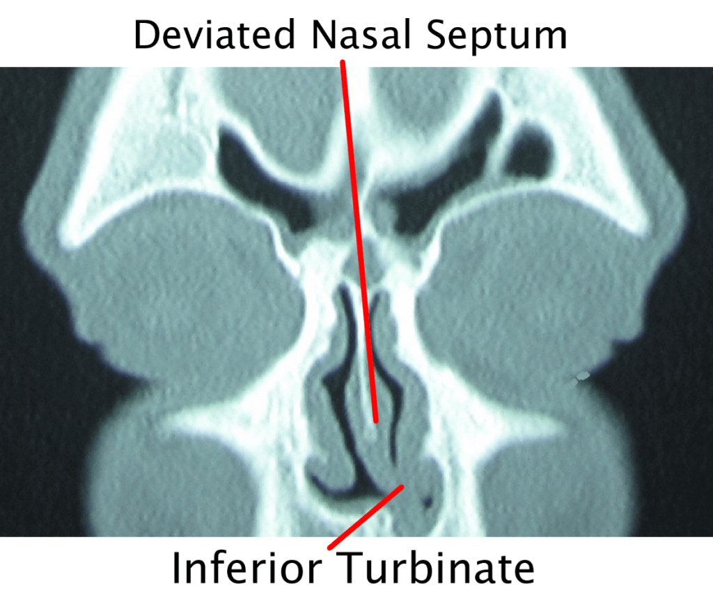 Deviated Septum | Norelle Health
