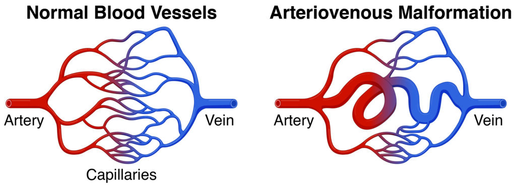 Arteriovenous malformation | Norelle Health