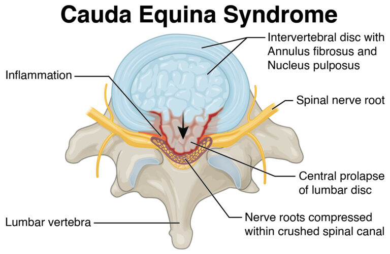 Cauda Equina Syndrome | Norelle Health