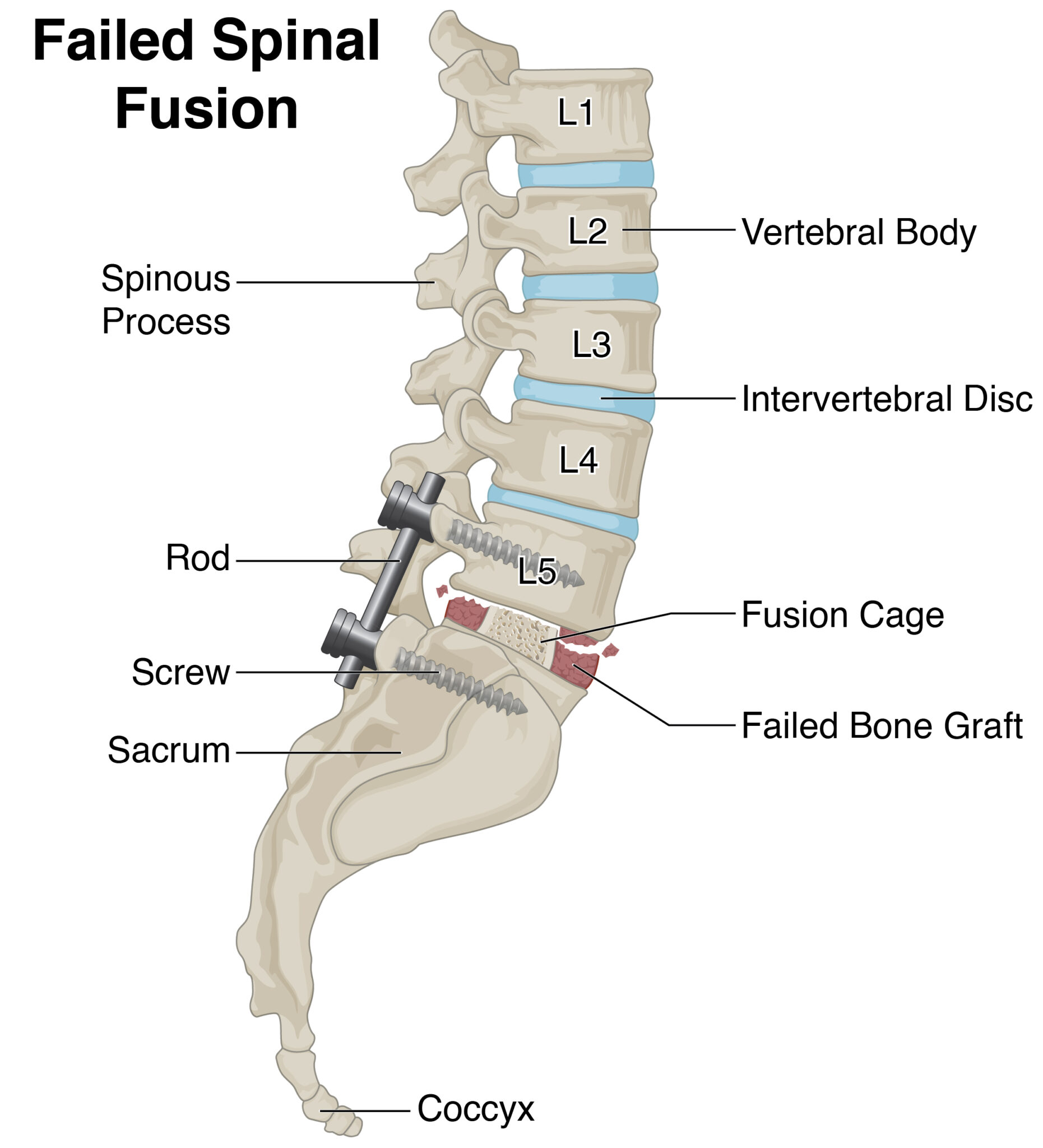 Failed Spinal Fusion | Norelle Health