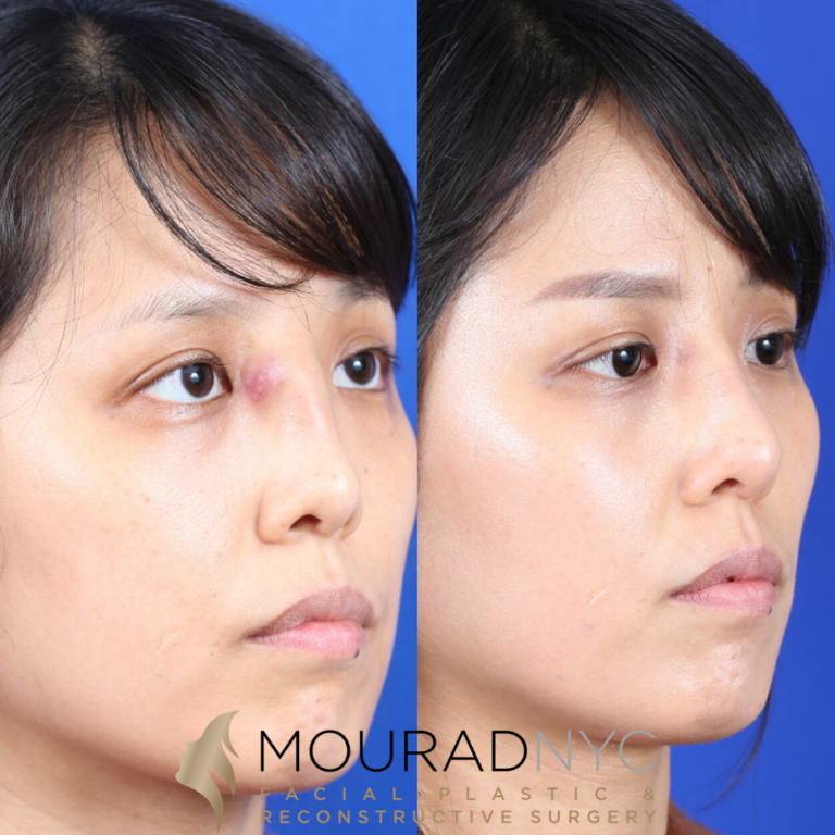 Revision Rhinoplasty | Norelle Health