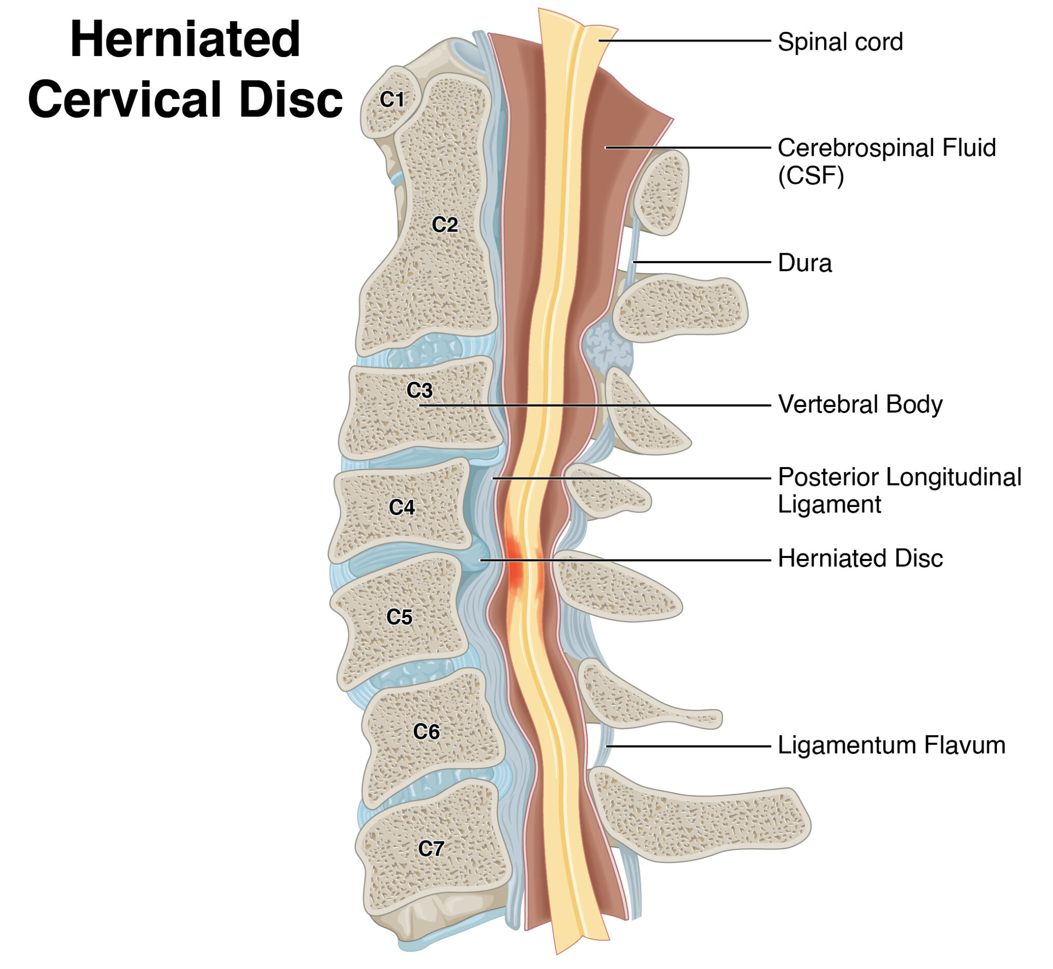 Herniated Discs | Norelle Health