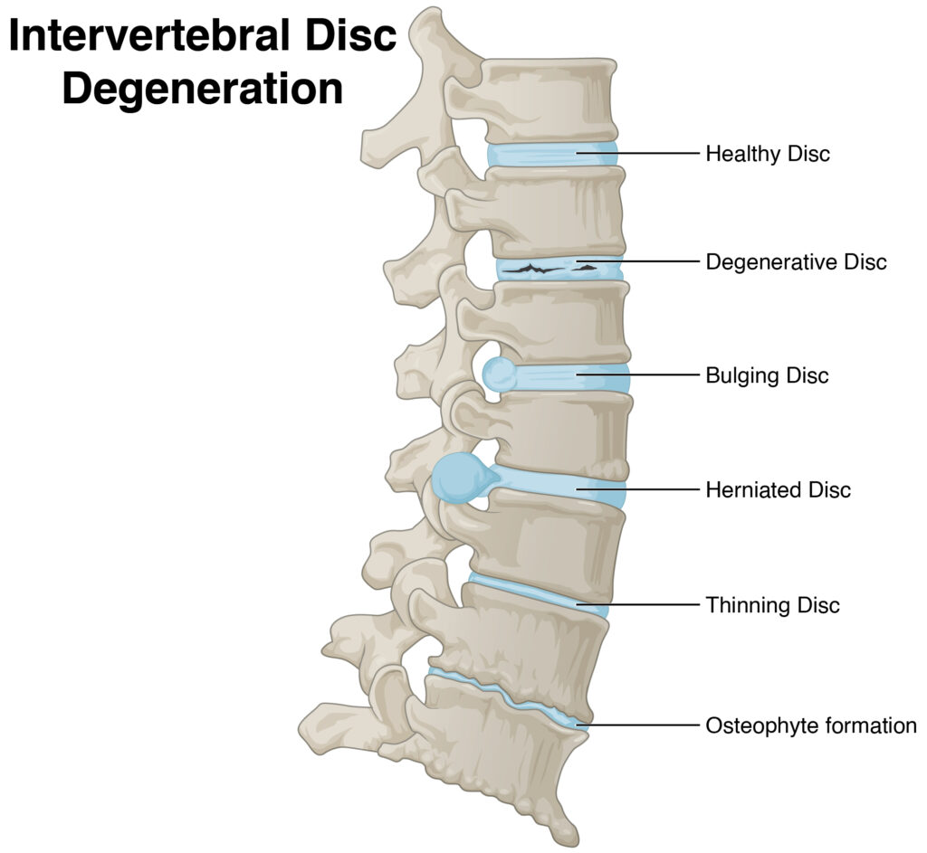 Degenerative Disc Disease | Norelle Health