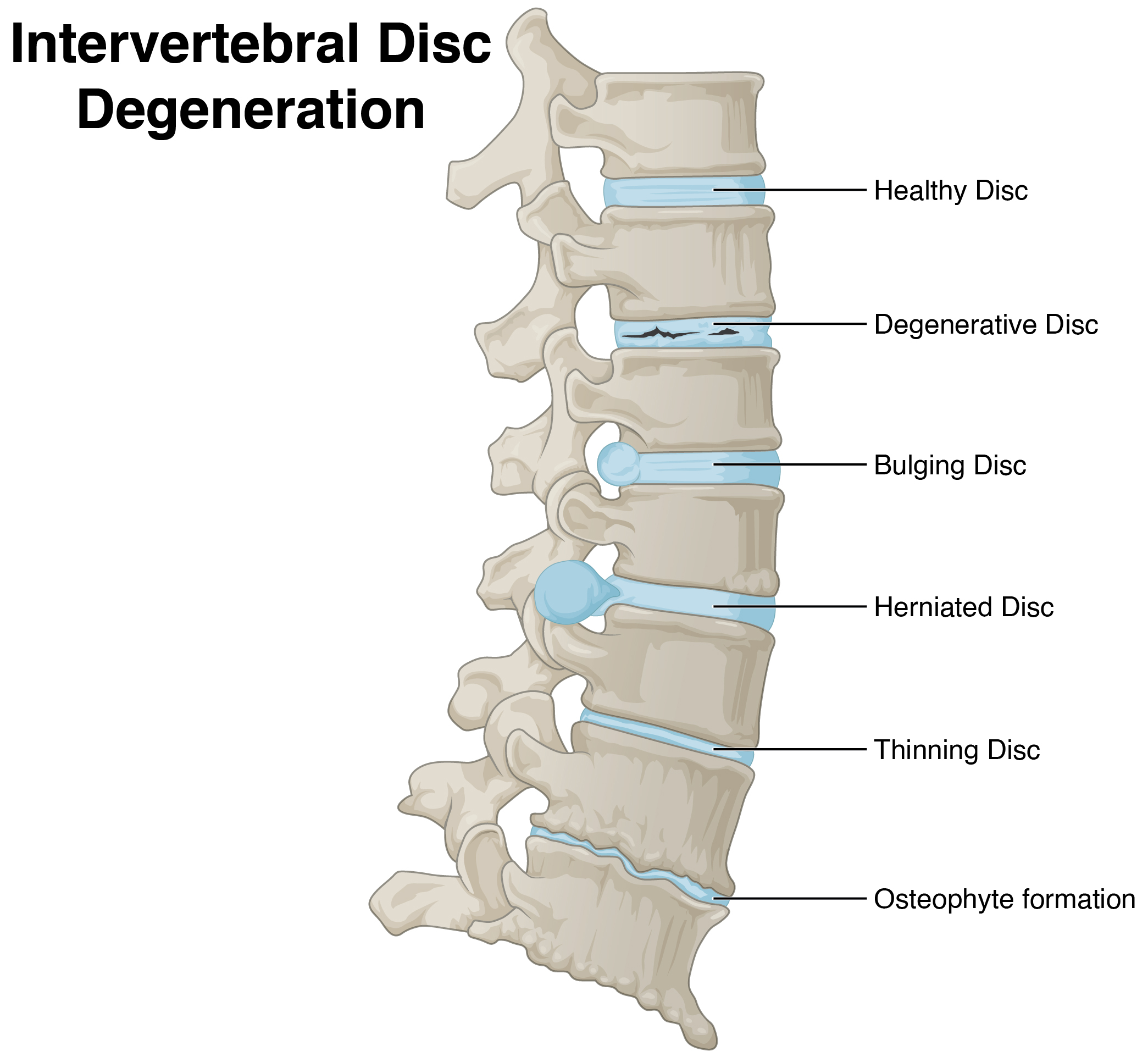 Degenerative Disc Disease | Norelle Health