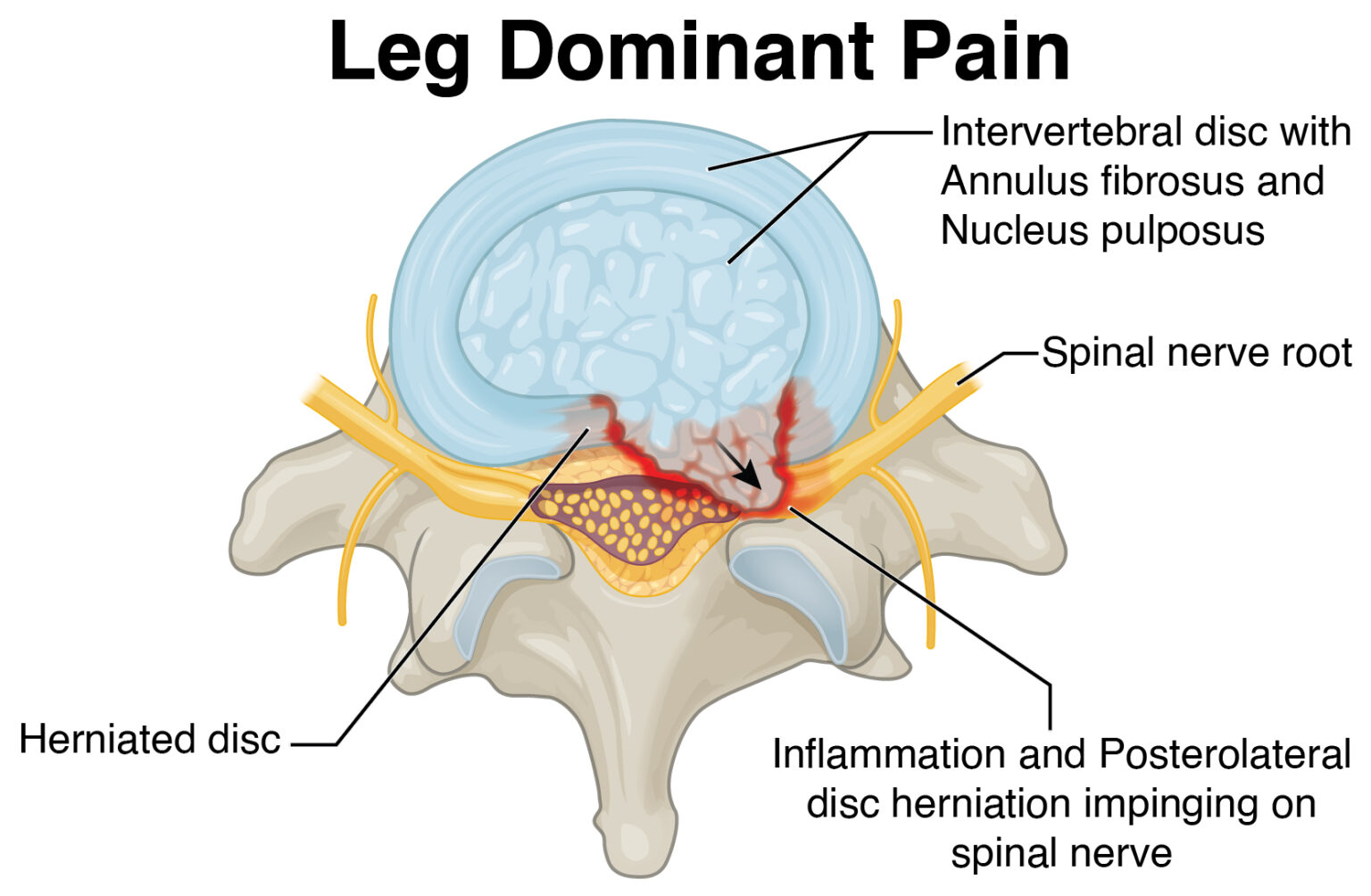Bulging Discs | Norelle Health