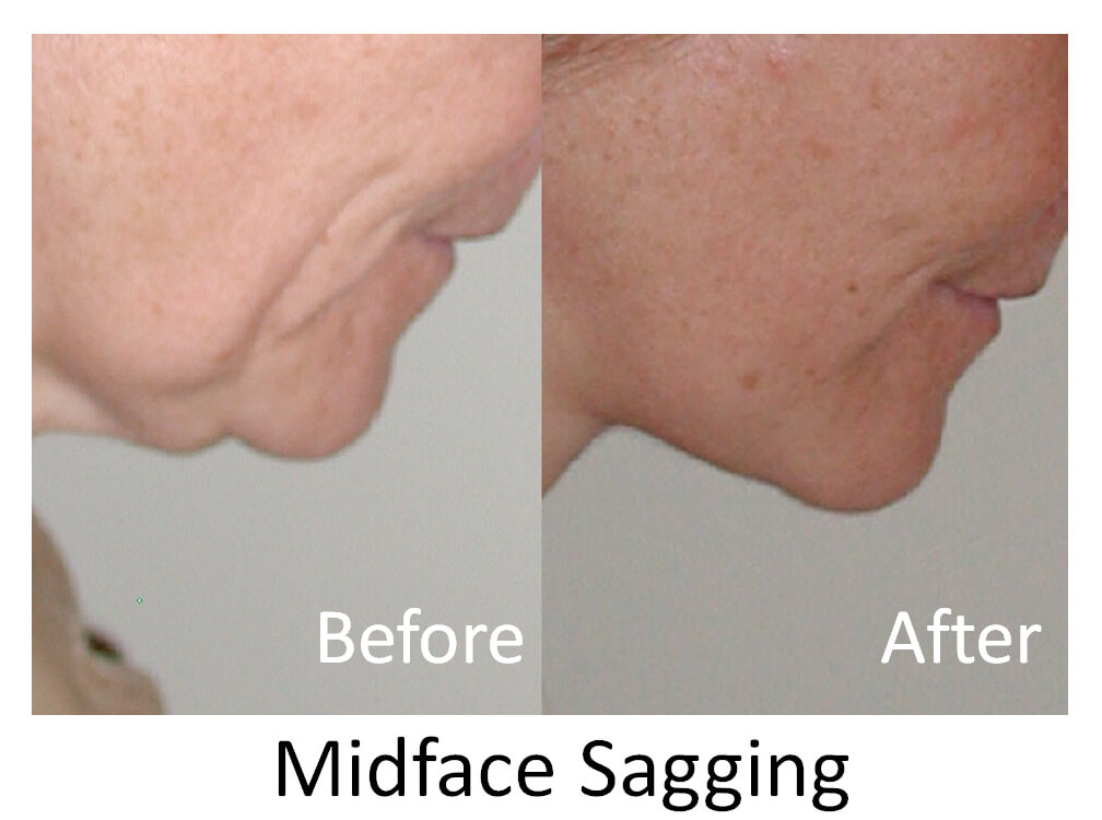 Facelift | Norelle Health