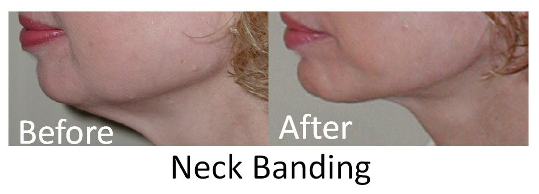 Facelift | Norelle Health