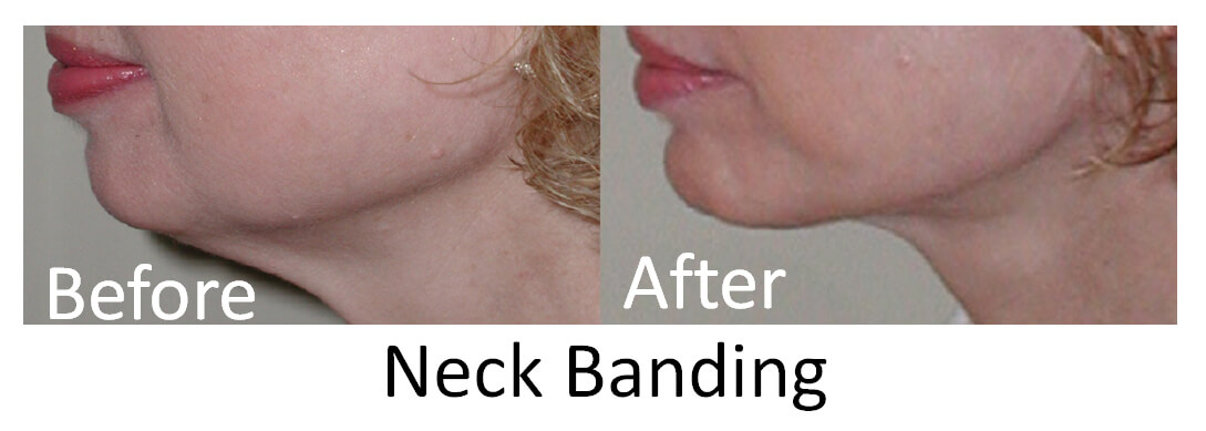 Facelift | Norelle Health