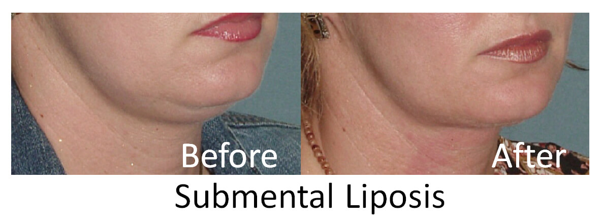 Facelift | Norelle Health