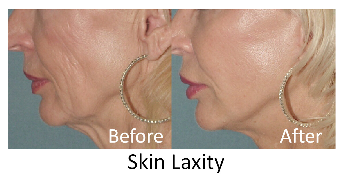 Facelift | Norelle Health