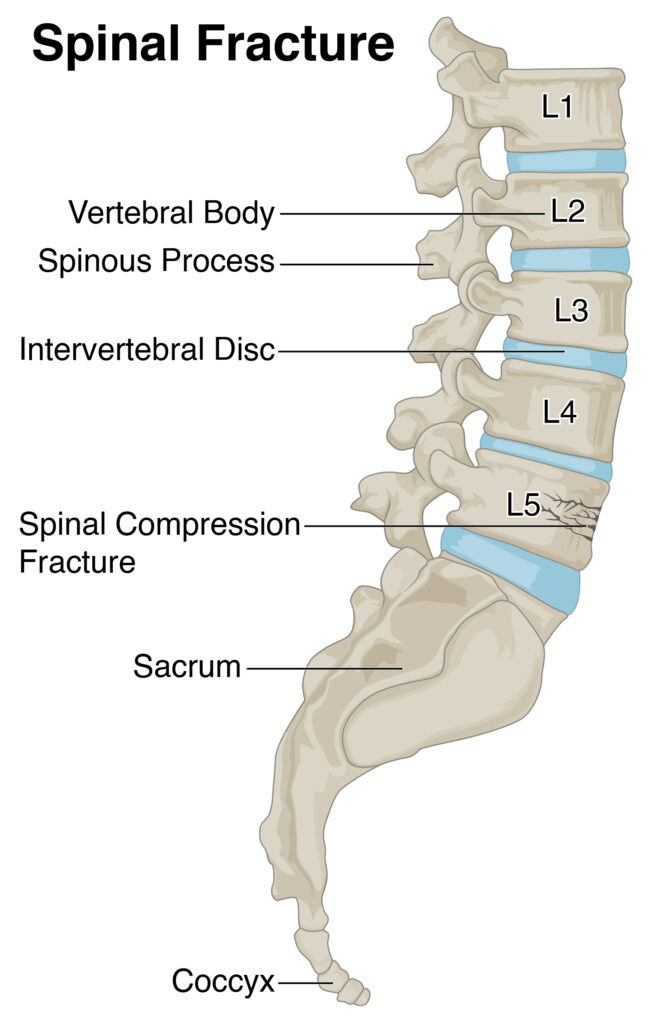 Spinal Fractures | Norelle Health