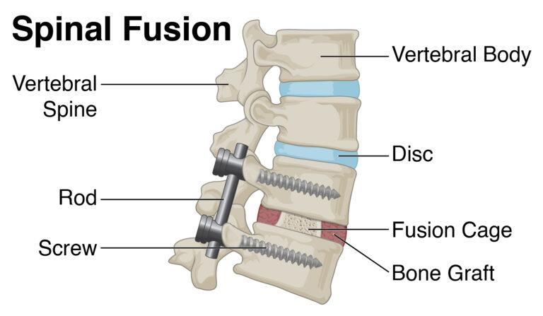 Fractured Spinal Hardware | Norelle Health