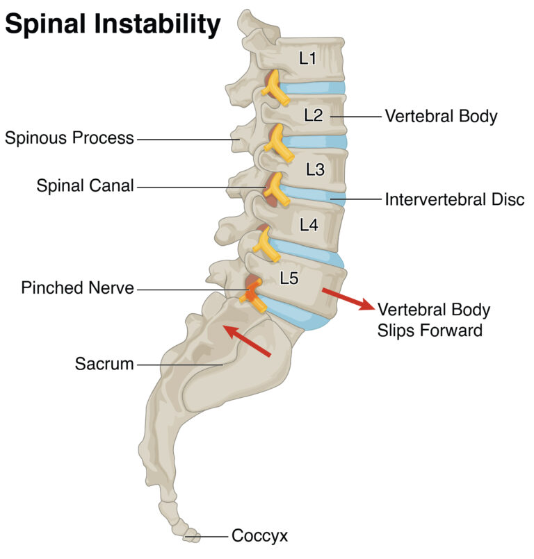 Spinal Instability | Norelle Health