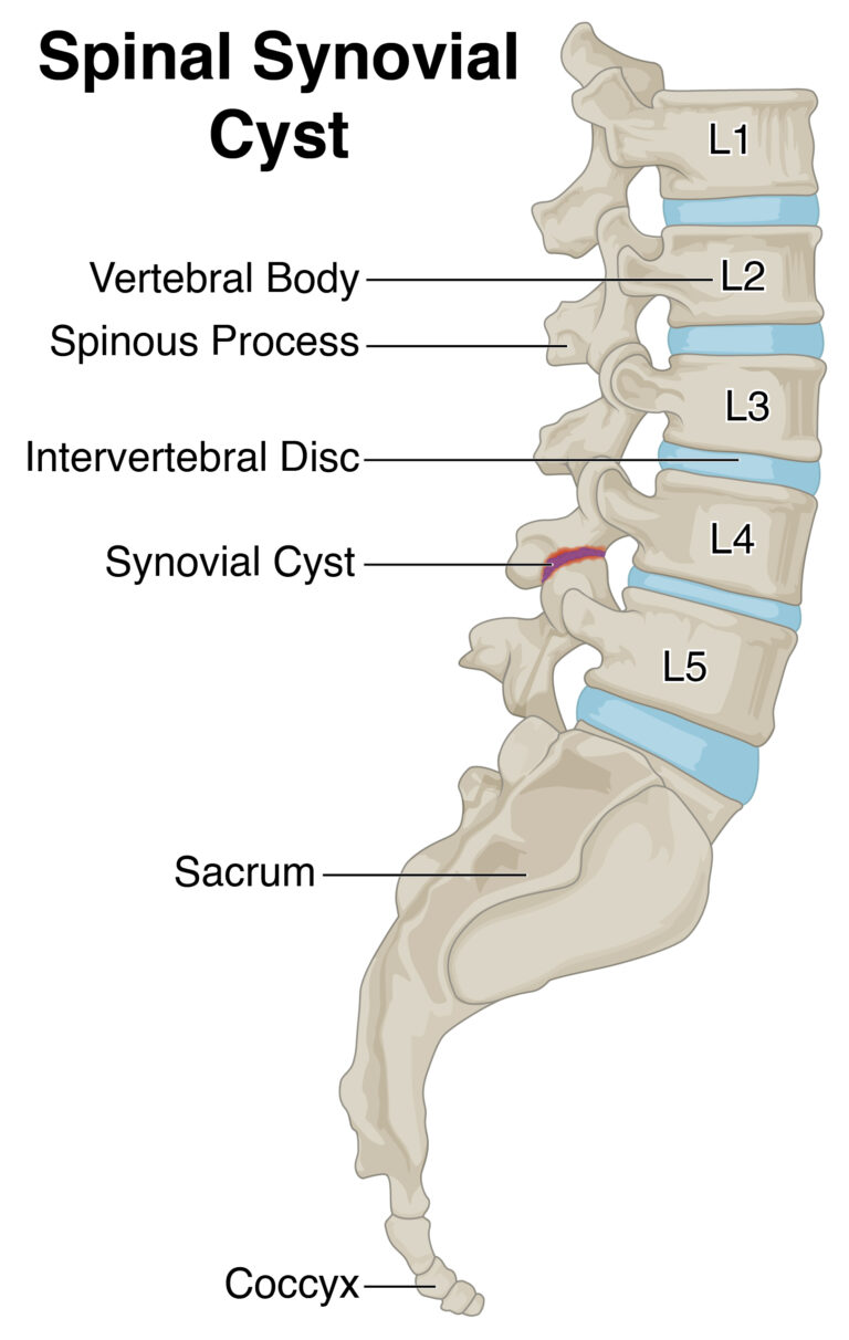 Synovial Cystst Norelle Health