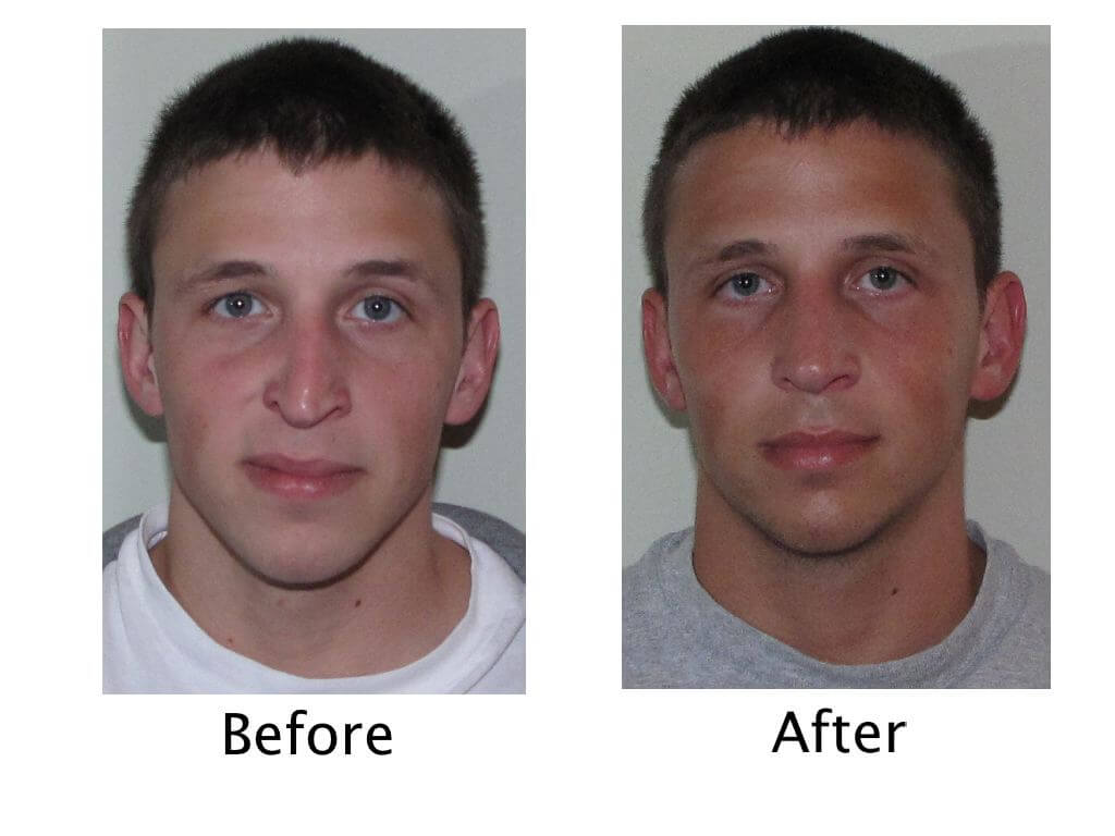 Functional Rhinoplasty | Norelle Health