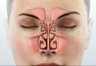 Understanding the Signs and Symptoms of Sinusitis | Norelle Health