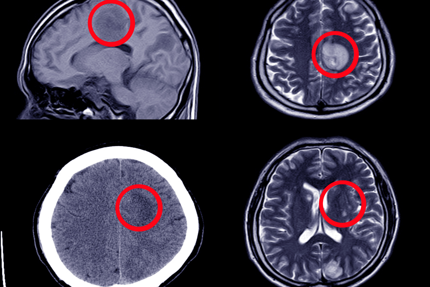 Hydrocephalus | Norelle Health