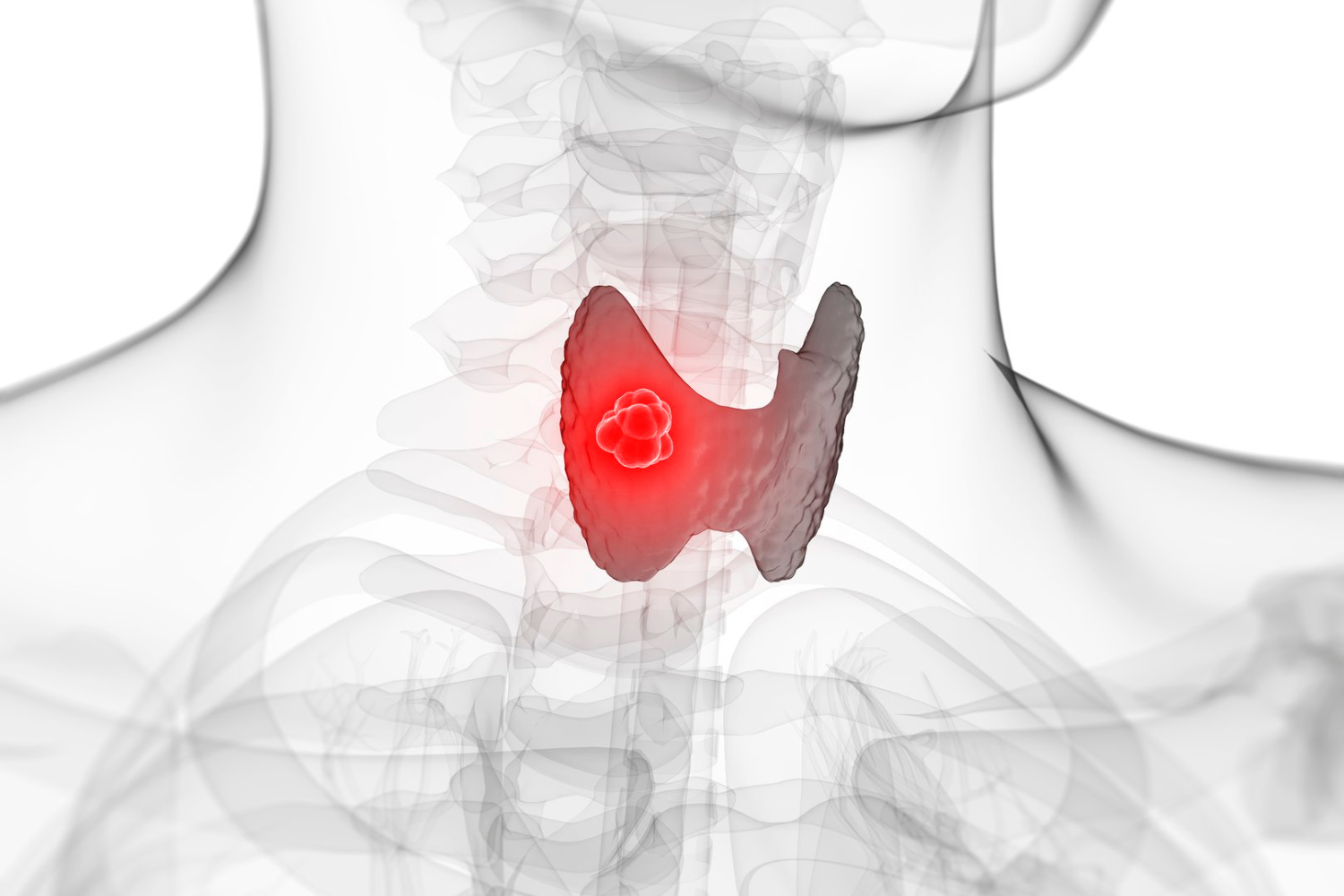 Thyroid Cancer | Norelle Health