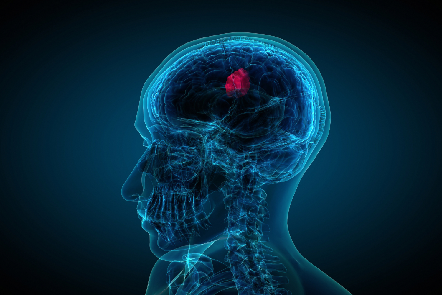 Brain Tumors | Norelle Health